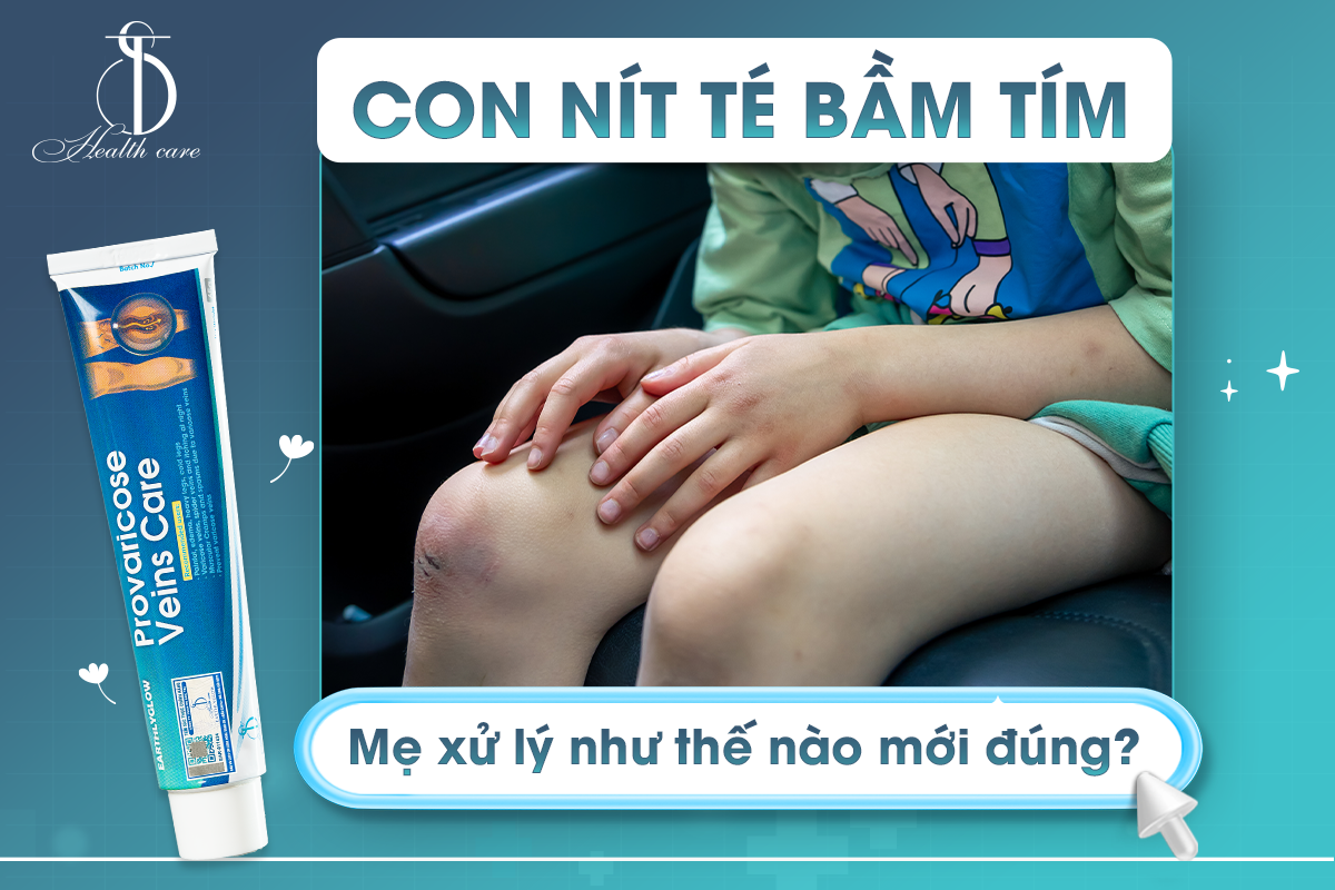 Con nít té bầm tím - mẹ xử lý như thế nào mới đúng?