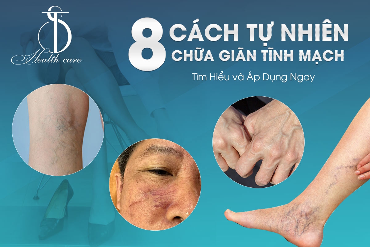 "8 Cách Tự Nhiên Chữa Giãn Tĩnh Mạch: Tìm Hiểu và Áp Dụng Ngay"