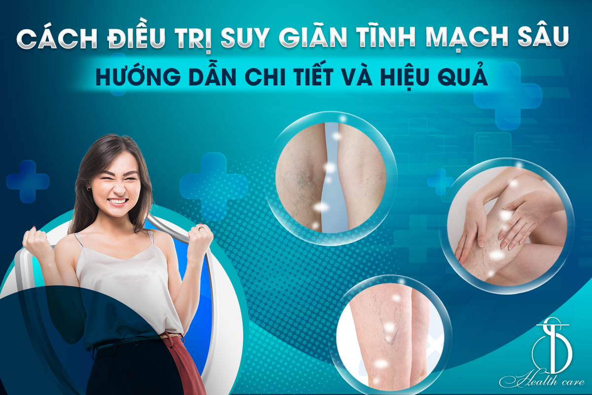 Cách Điều Trị Suy Giãn Tĩnh Mạch Sâu: Hướng Dẫn Chi Tiết và Hiệu Quả