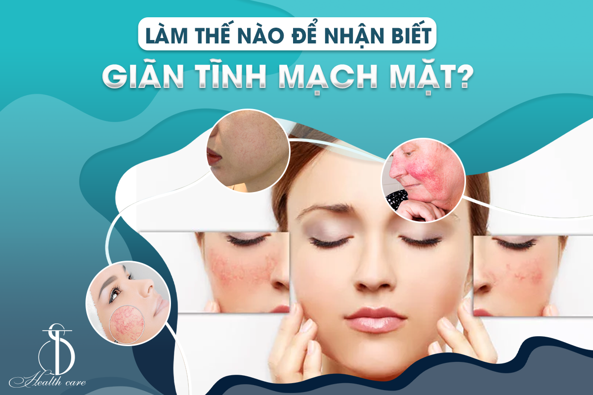 Làm Thế Nào Để Nhận Biết Giãn Tĩnh Mạch Mặt?